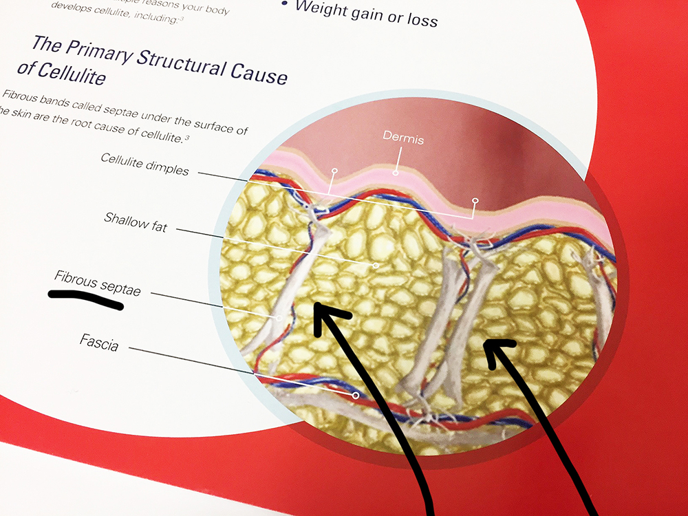 Cellfina Banished My Dimples: Watch me get treated! | MizzFIT